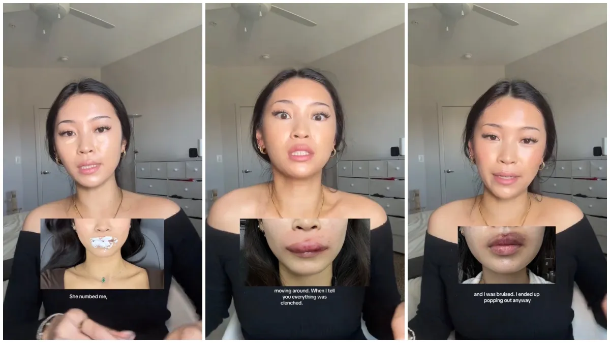 NYC woman gets lip filler for the first time for her birthday and ...